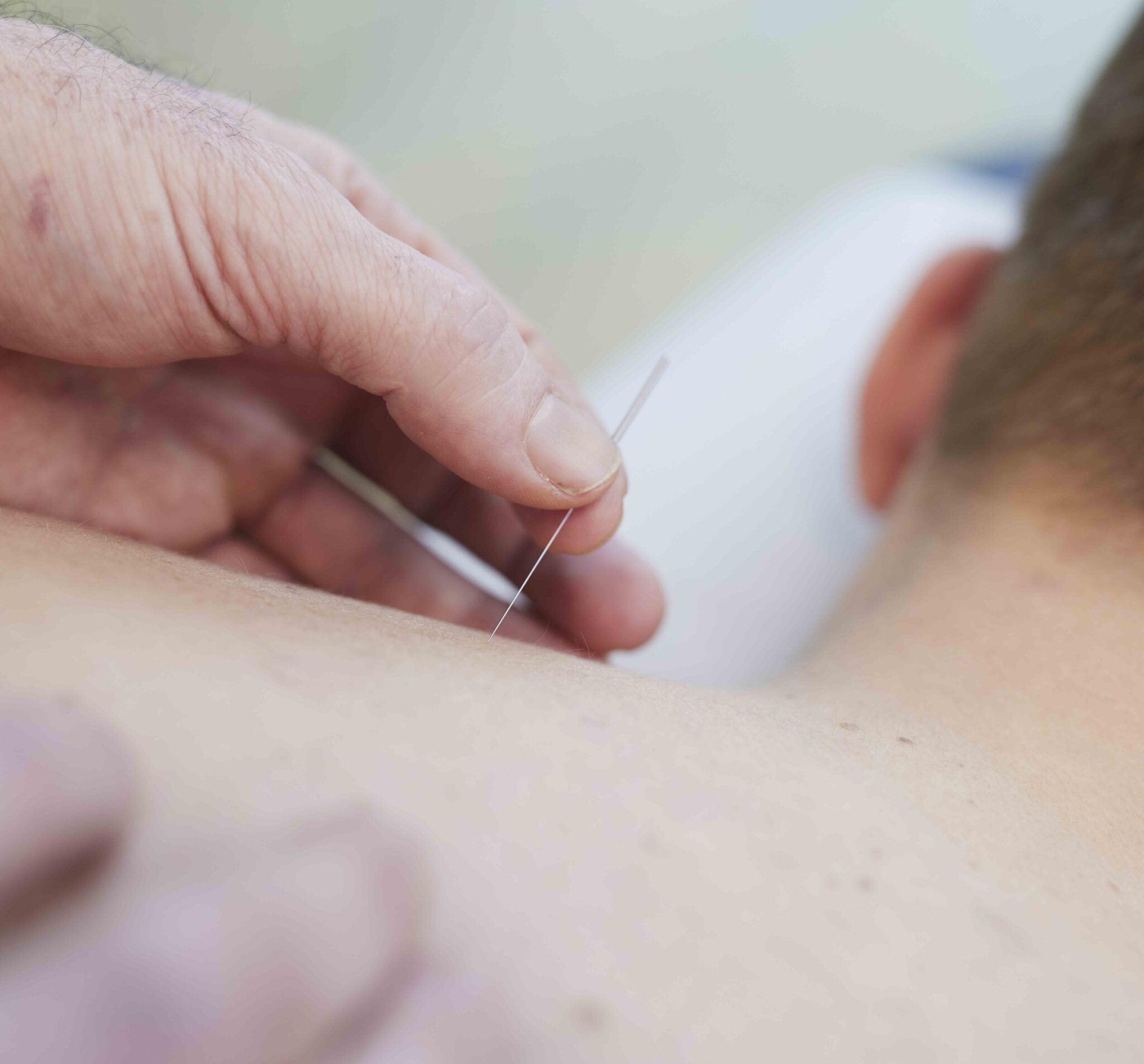 Spierscheur: Oorzaken, Symptomen & Behandeling | Spine Clinics